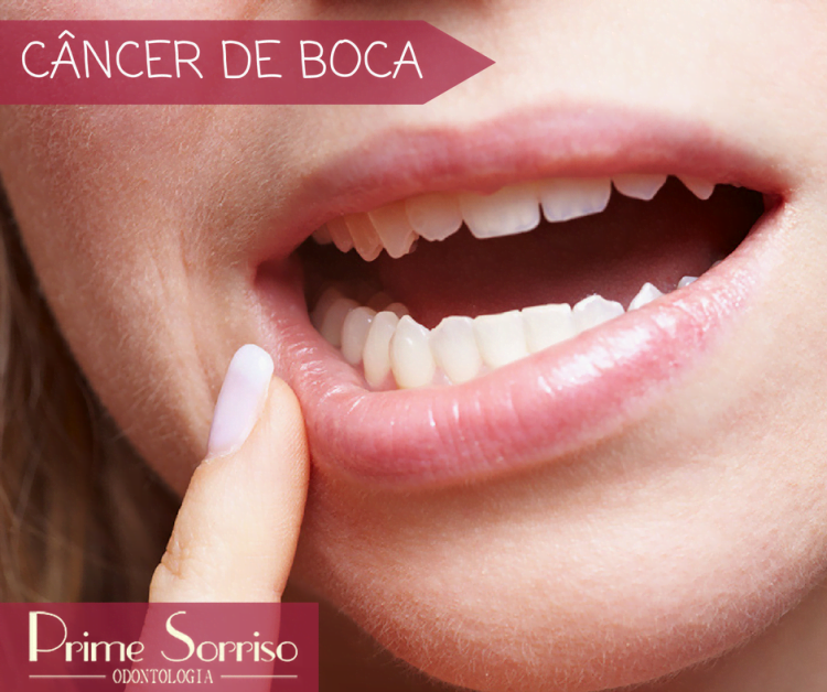 15.490 novos casos de câncer de boca são diagnosticados por ano no ...