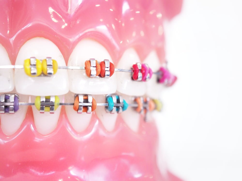 Aparelho fixo tradicional, é ultrapassado? - Prime Sorriso Foz