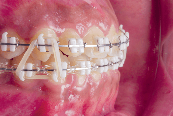 Elástico no aparelho fixo: qual sua função? - Prime Sorriso