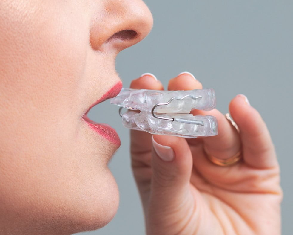 Aparelho ronco - Dentista em Foz do Iguaçu - Aparelho Ortodôntico ...