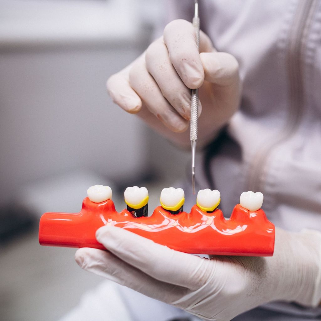 Como Escolher entre Implante Dentário e Ponte Fixa: Fatores a Considerar